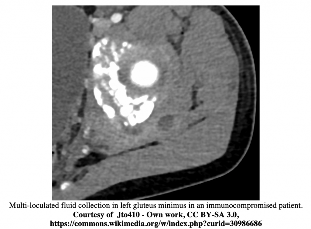 Pyomyositis: A Rare, but Life-Threatening Infection - emDocs