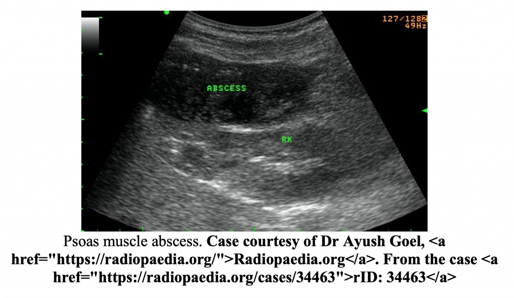 Pyomyositis: A Rare, but Life-Threatening Infection - emDocs