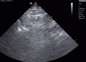 emDOCs.net – Emergency Medicine EducationVideo 2 - Intraluminal Gas ...