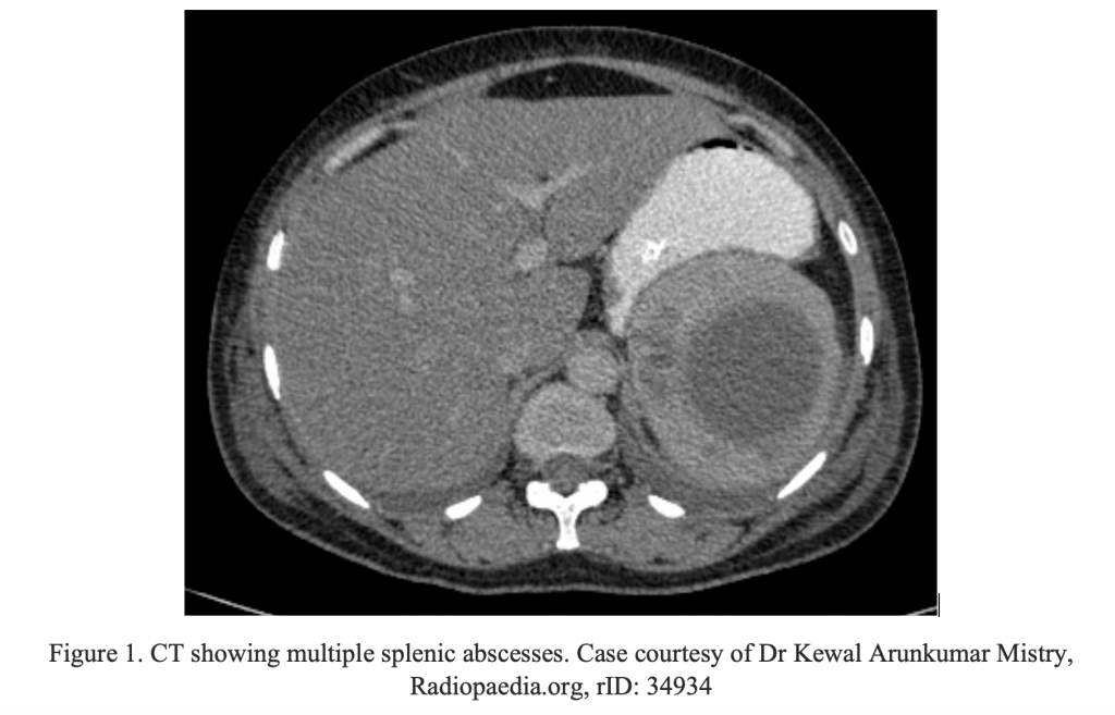 Splenic Abscess: ED Presentation, Evaluation, and Management - emDocs