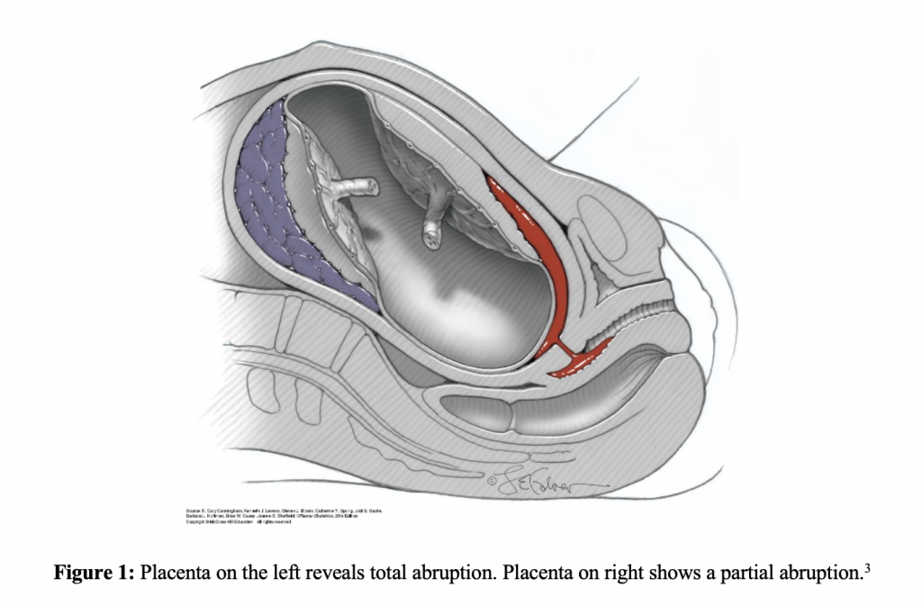 EM@3AM: Placental Abruption - emDocs
