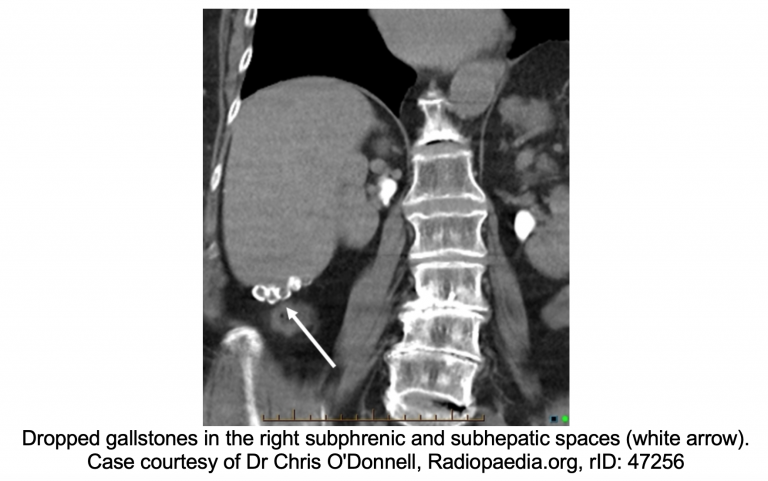 emDOCs.net – Emergency Medicine EducationCholecystectomy Complications ...