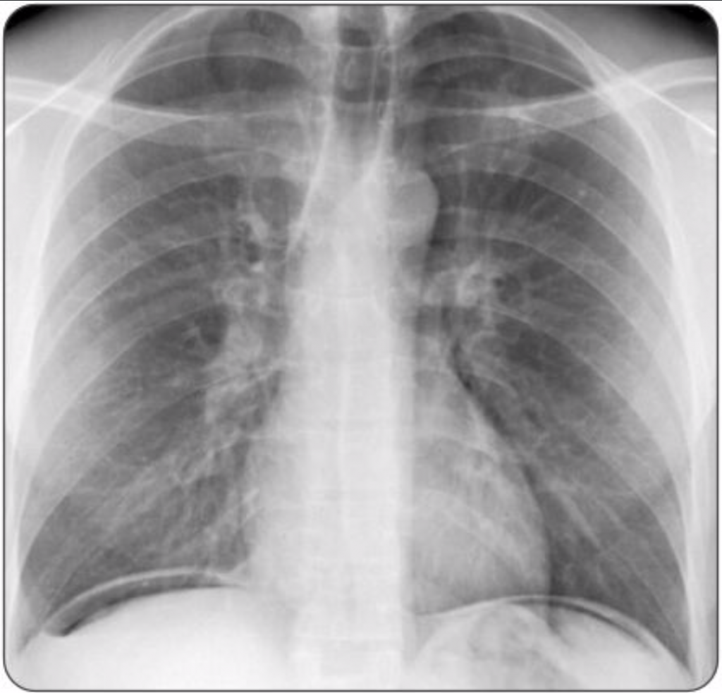 emDOCs.net – Emergency Medicine EducationEM@3AM: Viscous Perforation ...