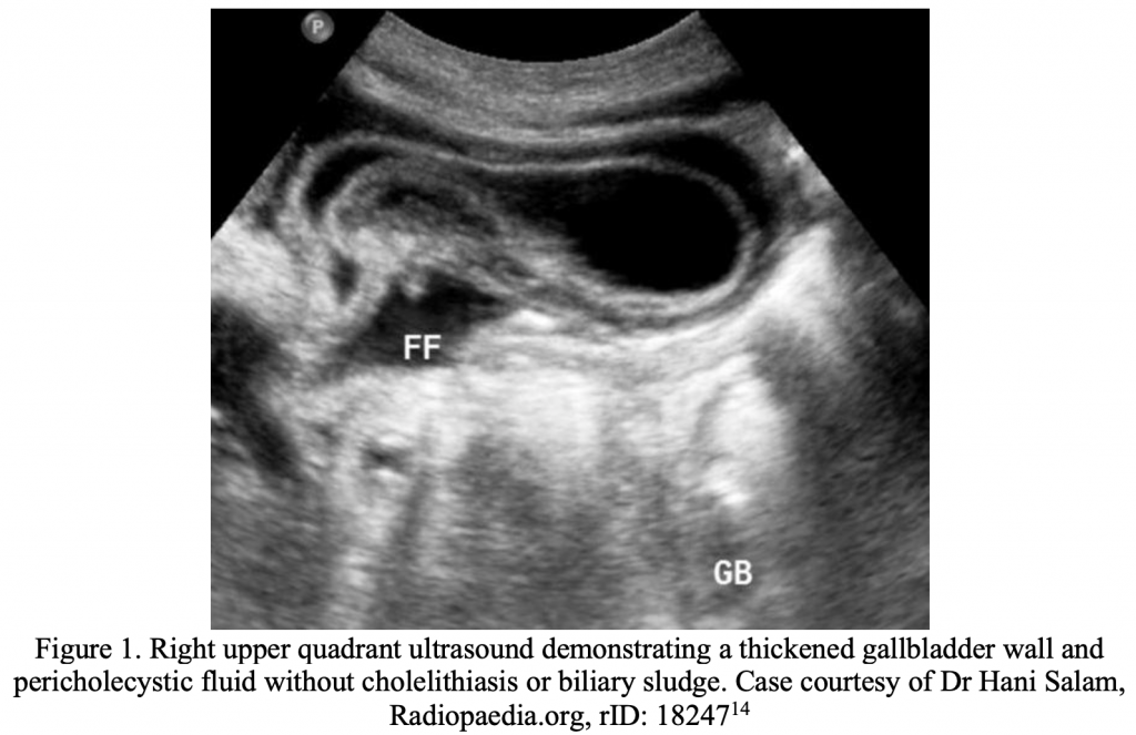 emDOCs.net – Emergency Medicine EducationAcute Acalculous Cholecystitis ...