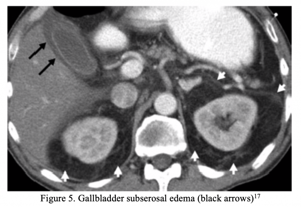 emDOCs.net – Emergency Medicine EducationAcute Acalculous Cholecystitis ...