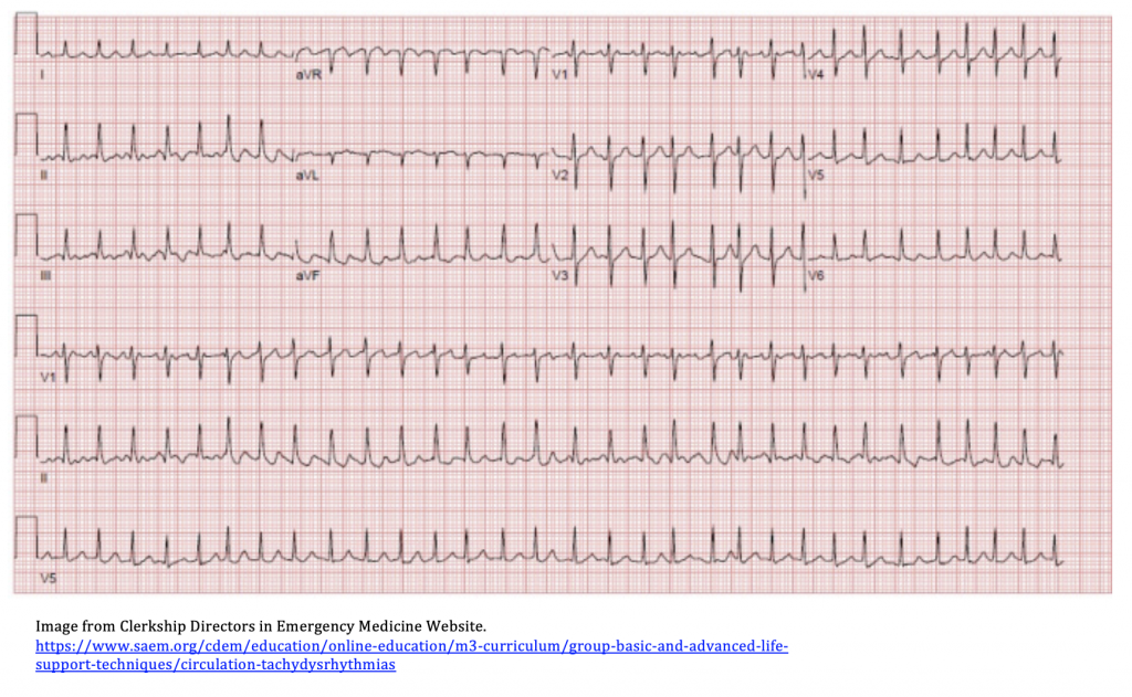 Unstable Atrial Fibrillation: A Guide to Management - emDocs
