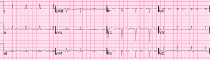 ECG Pointers: Post Myocardial Infarction Complications - LV Aneurysm ...