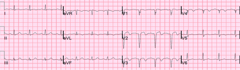 ECG Pointers: Post Myocardial Infarction Complications - LV Aneurysm ...