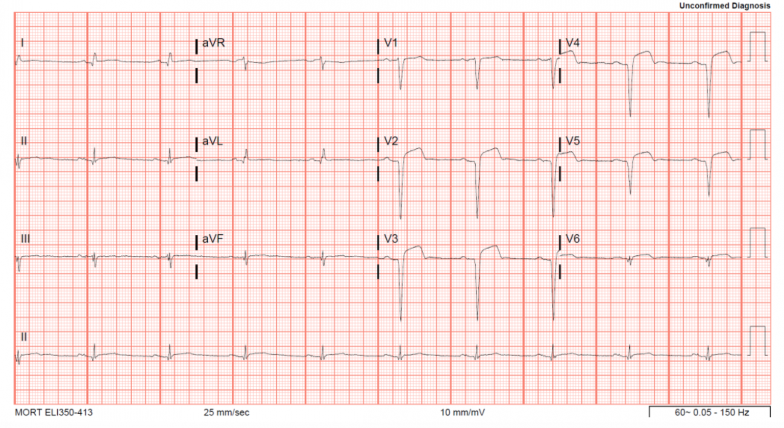 ECG Pointers: Post Myocardial Infarction Complications - LV Aneurysm ...