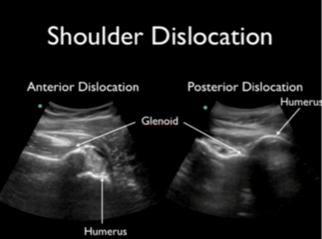 EM@3AM: Anterior Shoulder Dislocation - emDocs