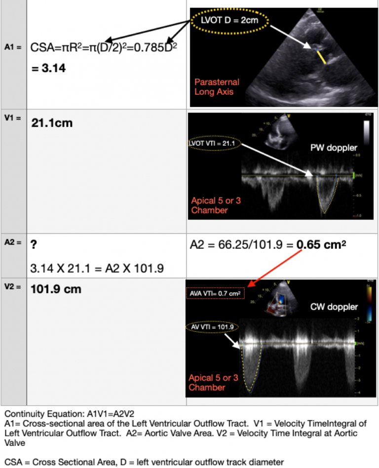emDOCs.net – Emergency Medicine EducationPOCUS for Aortic Stenosis ...
