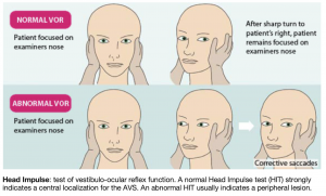 emDOCs.net – Emergency Medicine EducationPosterior Circulation Strokes ...