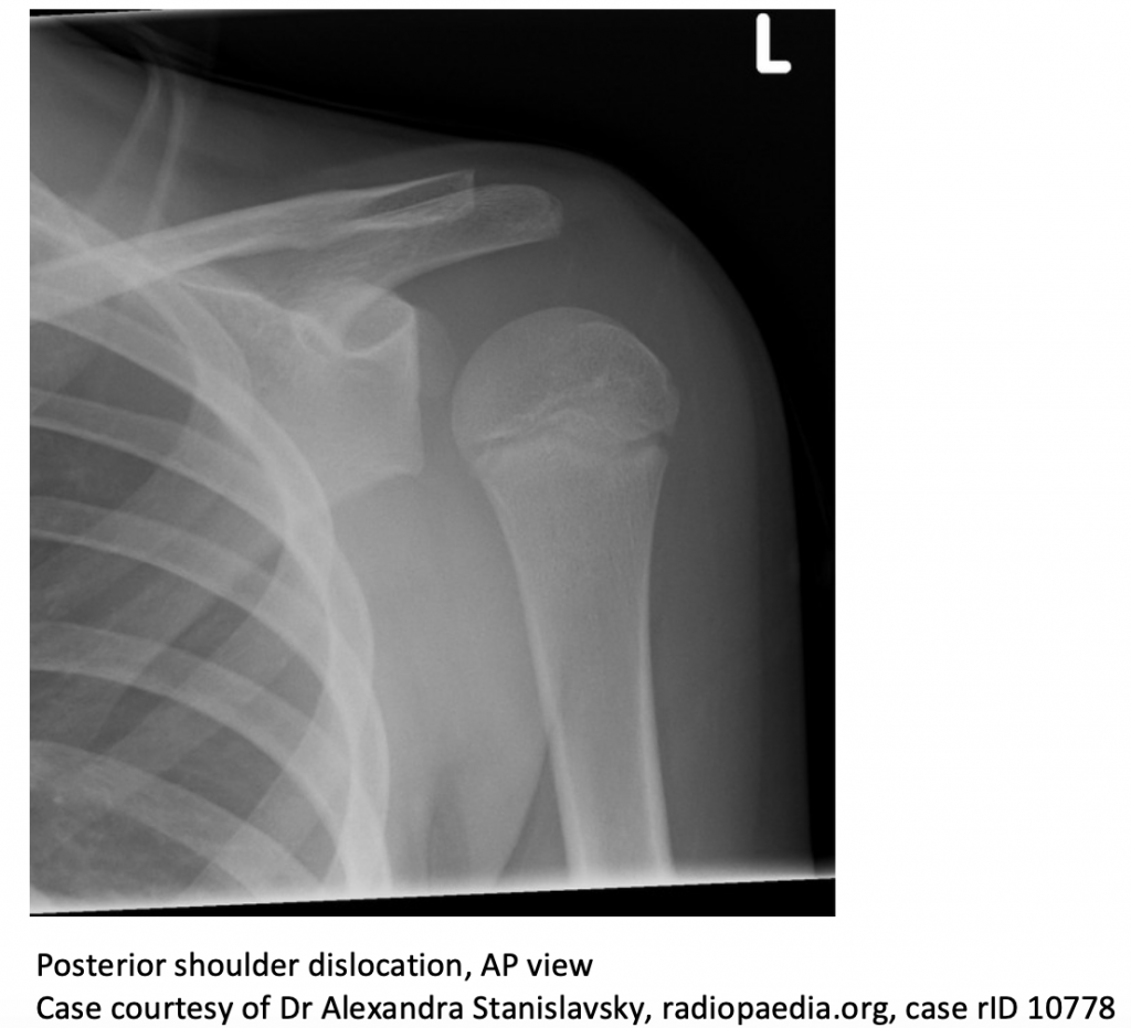 emDOCs.net – Emergency Medicine EducationEM@3AM: Posterior Shoulder ...