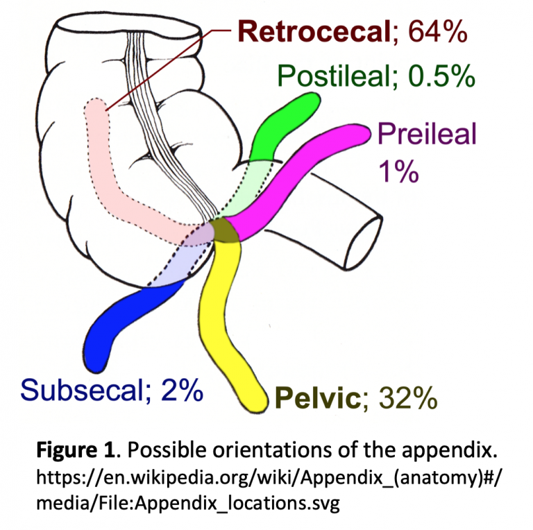 Appendicitis: Why Do We Miss It, and How Do We Improve? - emDocs