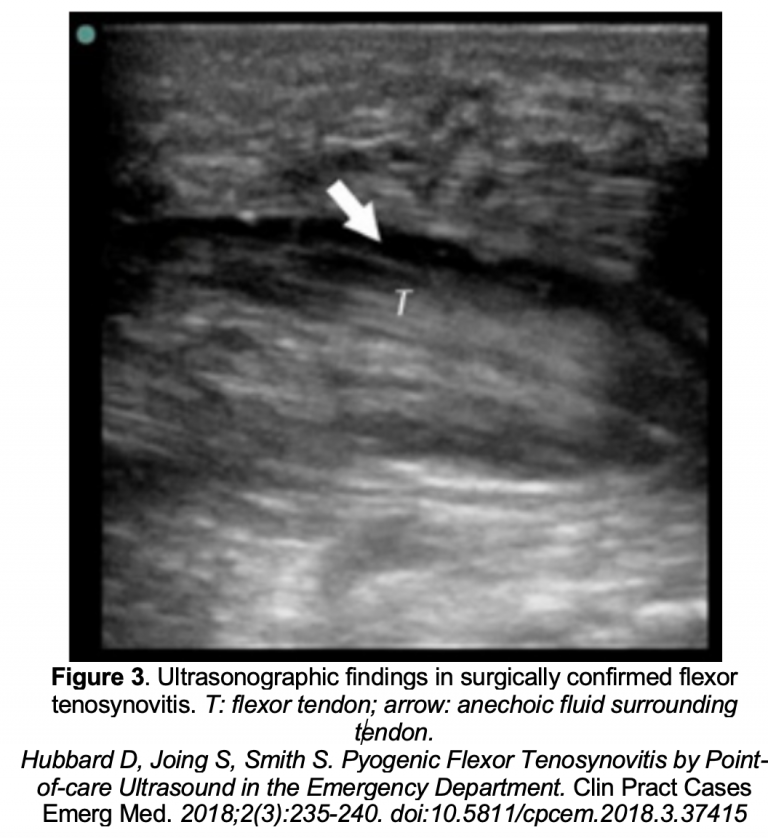 emDOCs.net – Emergency Medicine EducationEM@3AM: Pyogenic Flexor ...