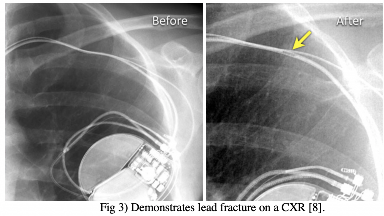EM@3AM: Pacemaker/AICD Complications - emDocs
