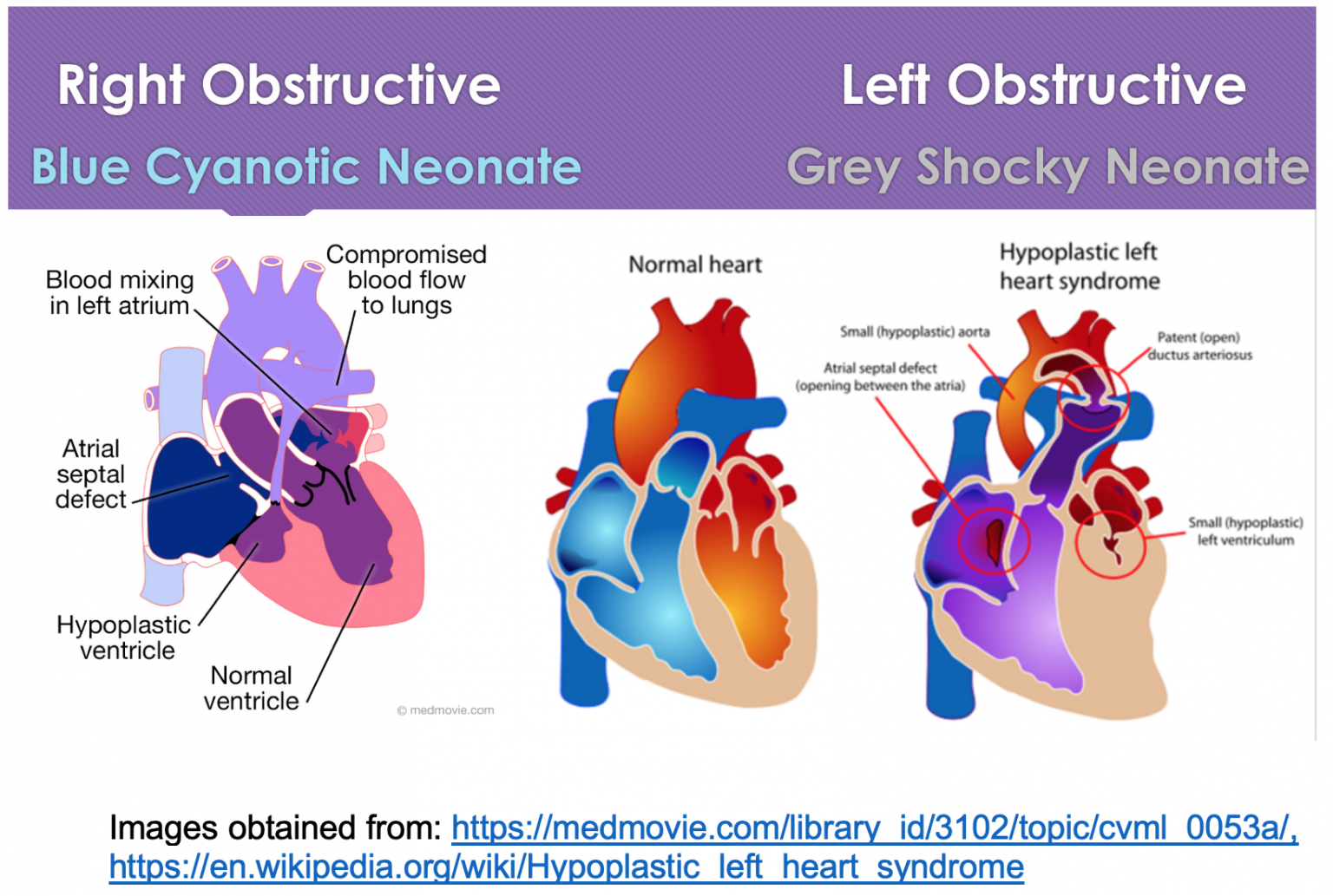 emDOCs.net – Emergency Medicine EducationEM@3AM: Blue Baby - emDOCs.net ...