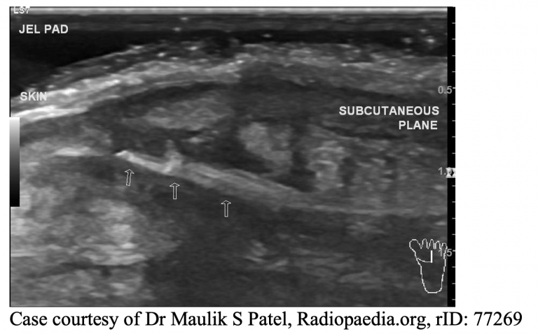 Puncture Wounds: ED presentations, evaluation, and management - emDocs