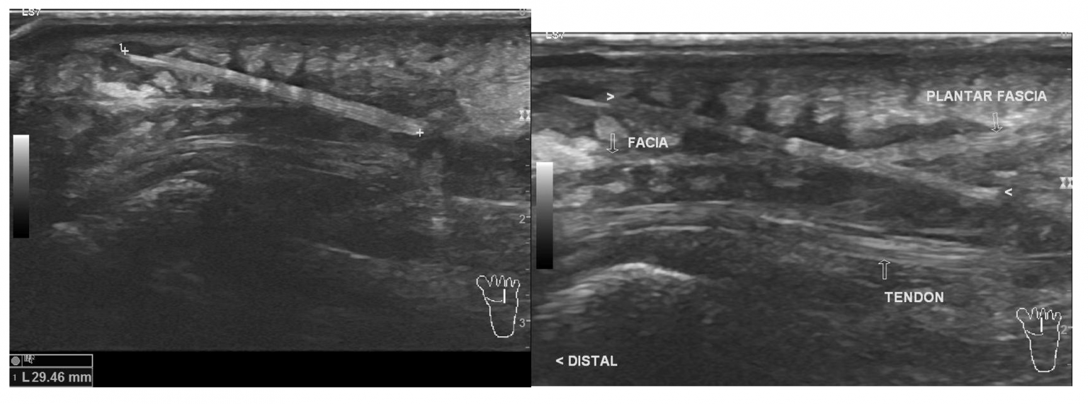 emDOCs.net – Emergency Medicine EducationPuncture Wounds: ED ...
