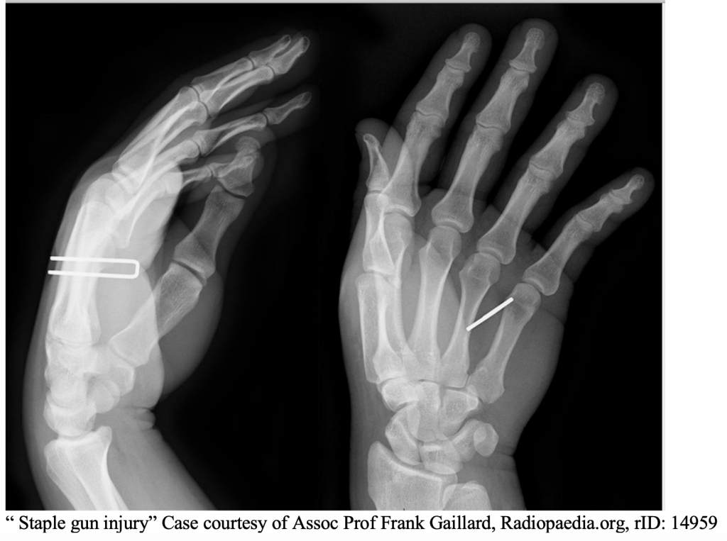 emDOCs.net – Emergency Medicine EducationSoft Tissue Foreign Bodies: ED ...