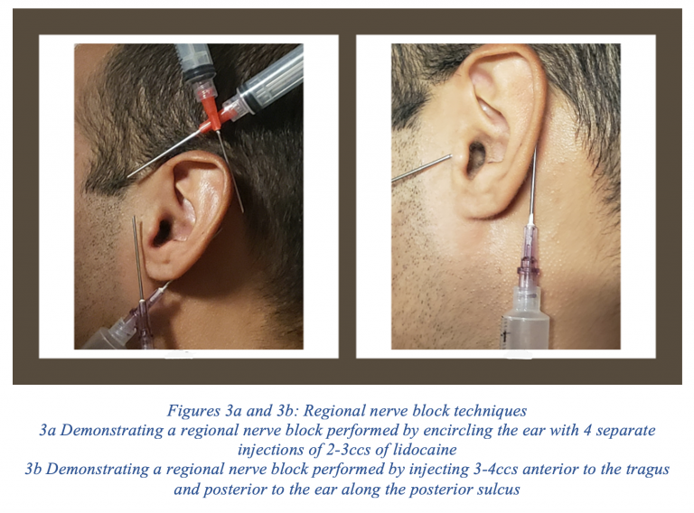 emDOCs.net – Emergency Medicine EducationPreventing Scarface: Pearls ...