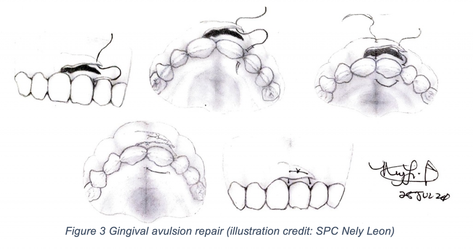 emDOCs.net – Emergency Medicine EducationPreventing Scarface: Pearls ...