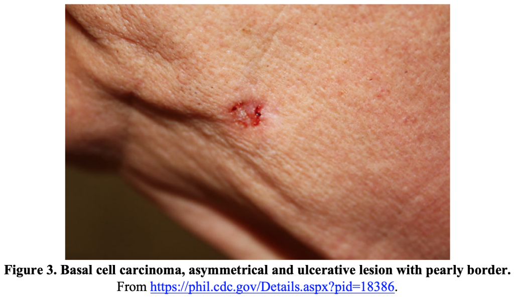 emDOCs.net – Emergency Medicine EducationRecognizing Skin Cancer in the ...