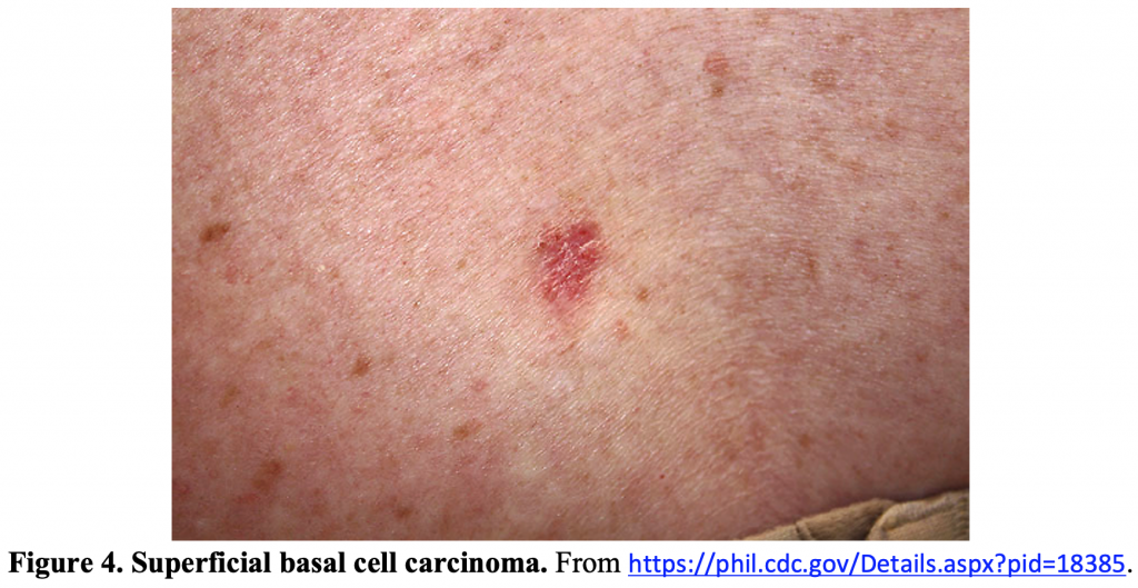 emDOCs.net – Emergency Medicine EducationRecognizing Skin Cancer in the ...