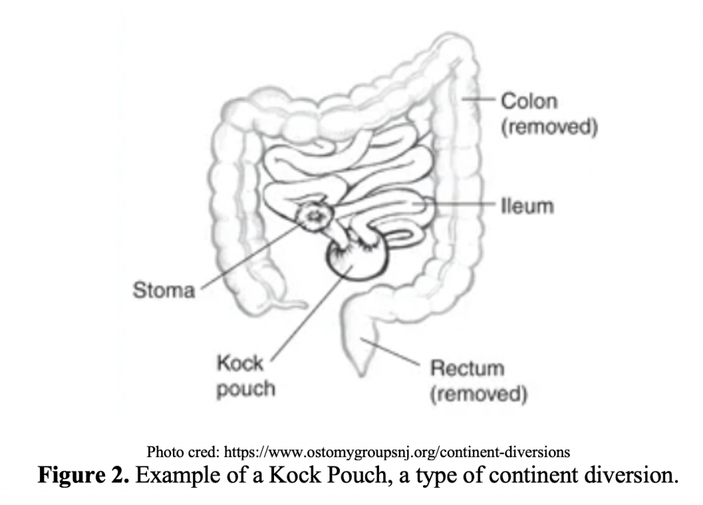 Ostomy complications: ED presentations, complications, and management ...