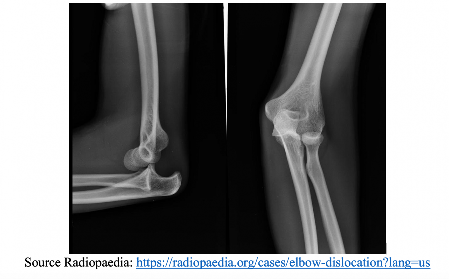 EM@3AM: Elbow Dislocation - emDocs