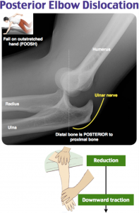 EM@3AM: Elbow Dislocation - emDocs