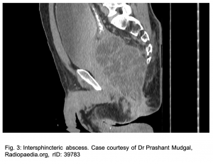 Anorectal Abscesses: ED Clinical Presentation, Evaluation, and ...