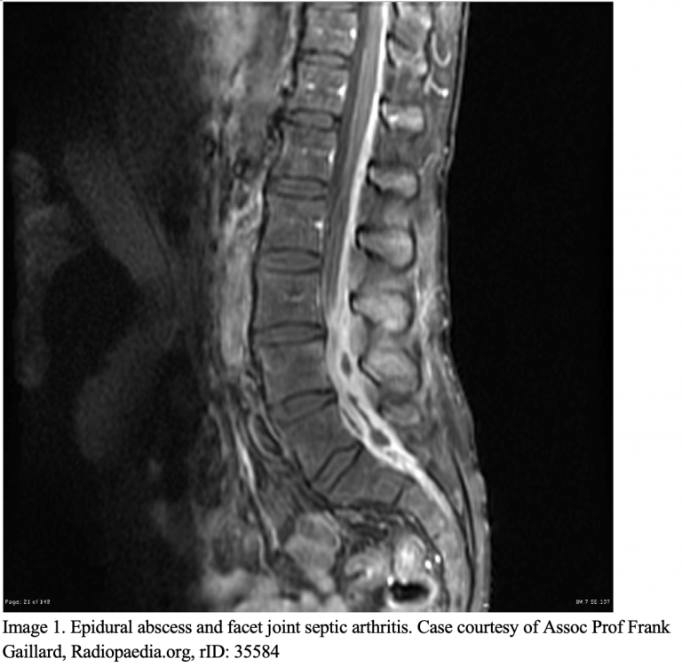 Spinal Epidural Abscess: Challenges to Diagnosis and How to Improve ...