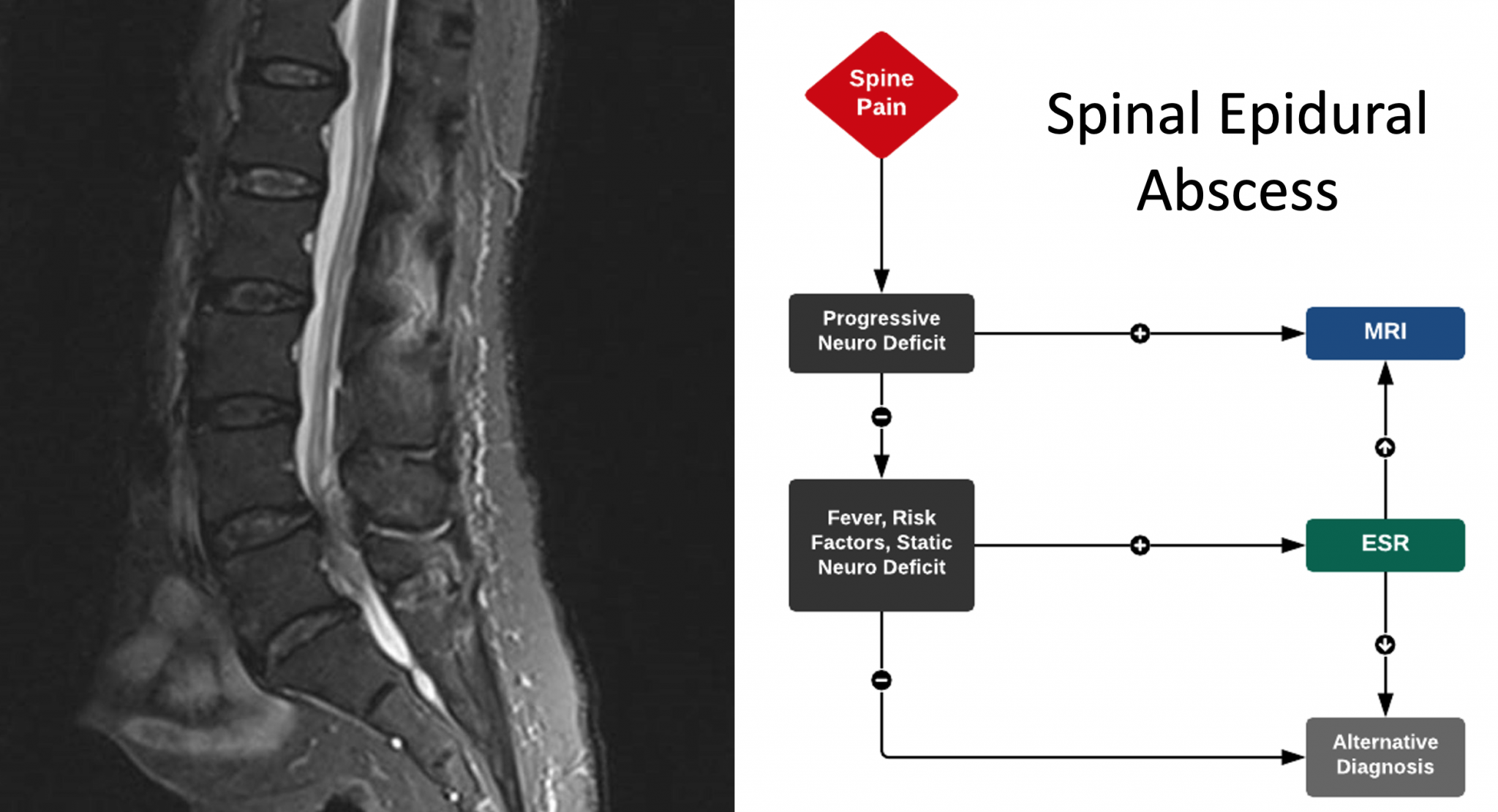 Spinal Epidural Abscess: Challenges to Diagnosis and How to Improve - emDocs