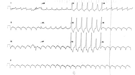 emDOCs.net – Emergency Medicine EducationLewis lead ECG - emDOCs.net ...
