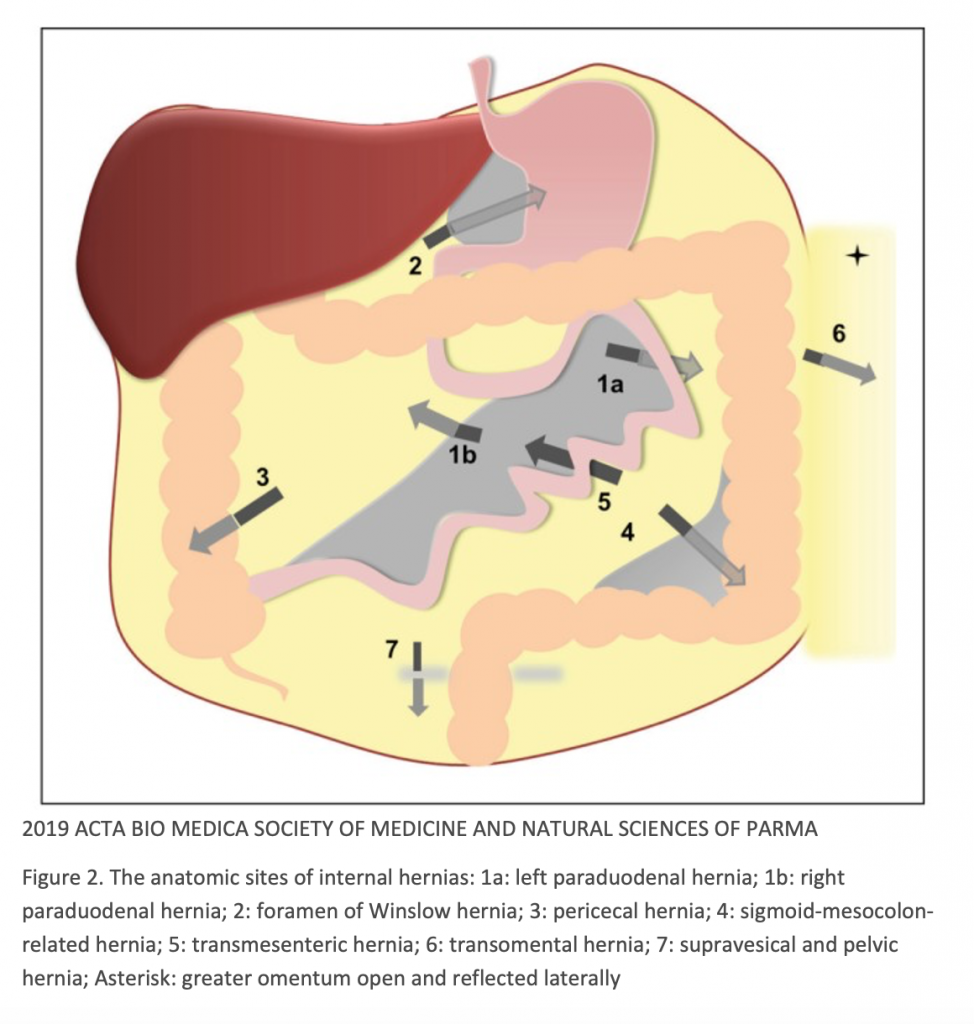 Internal Hernias: A Rare But Cannot Miss Diagnosis - emDocs