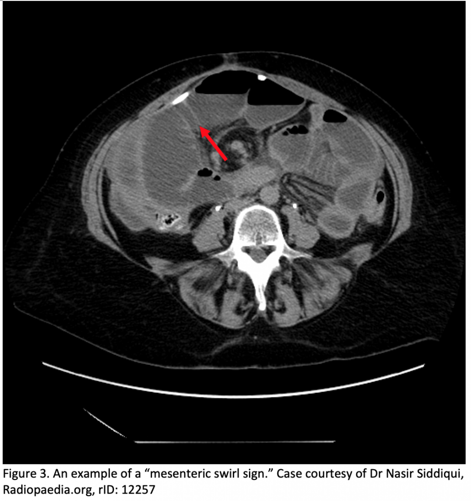 Internal Hernias: A Rare But Cannot Miss Diagnosis - emDocs