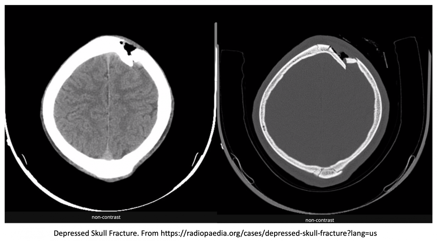 emDOCs.net – Emergency Medicine EducationBursting at the Skull: Skull ...