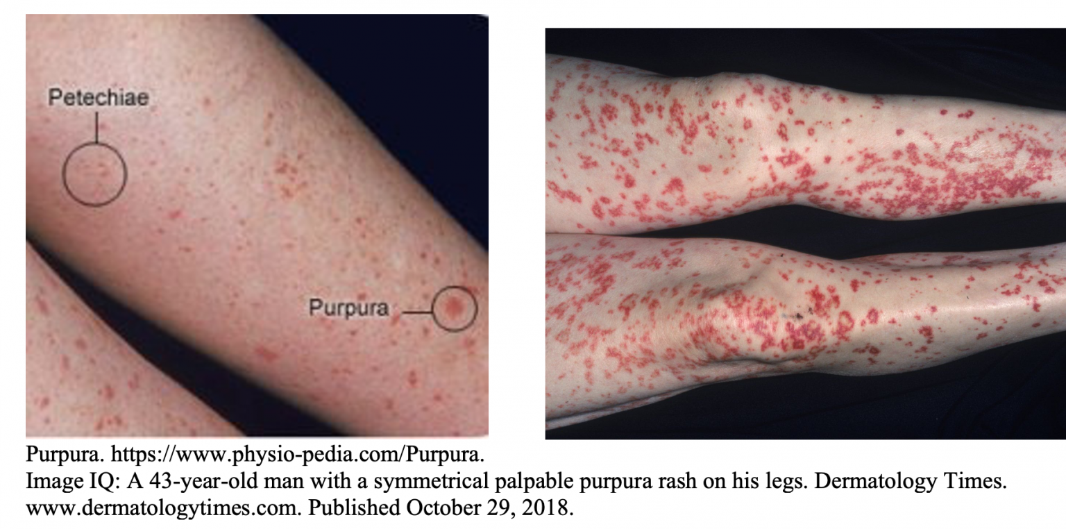 EM@3AM: Purpura - emDocs