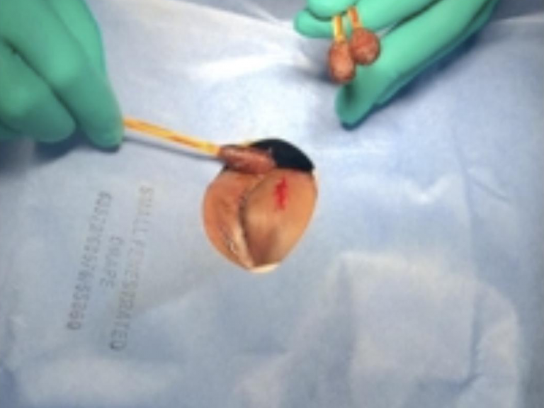 Unlocking Common ED Procedures: Lateral Canthotomy and Cantholysis - emDocs