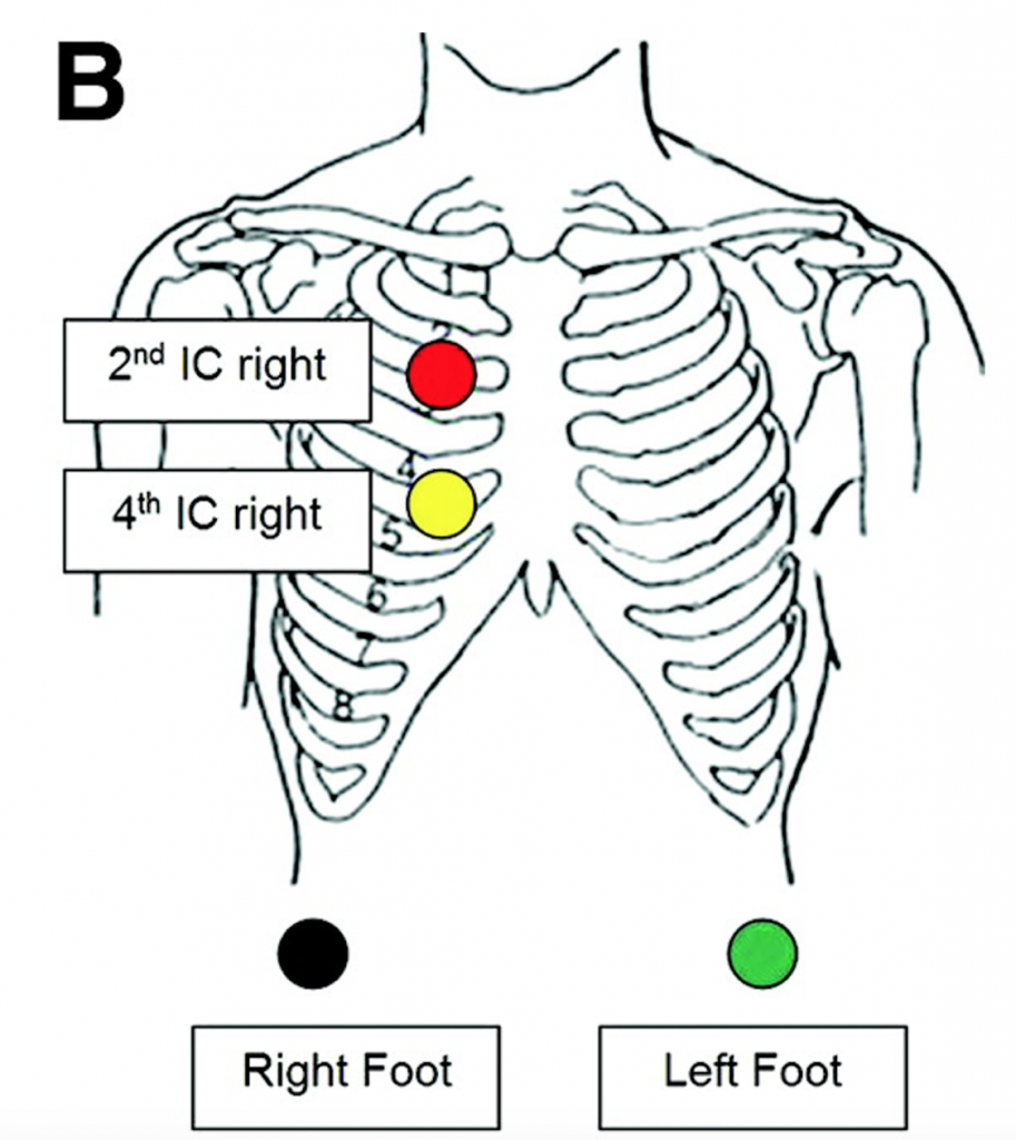 ECG Pointers – The Lewis Lead - emDocs