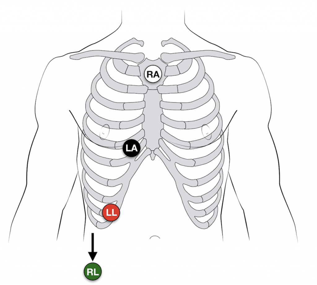ECG Pointers – The Lewis Lead - emDocs