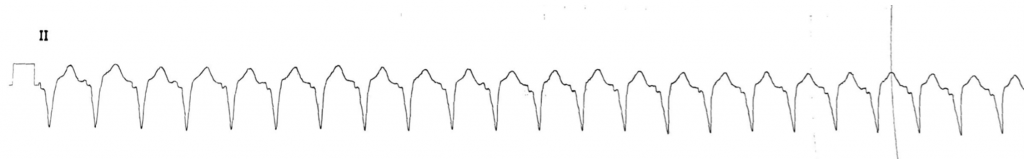 ECG Pointers – The Lewis Lead - emDocs