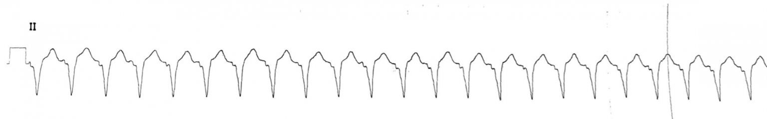 ECG Pointers – The Lewis Lead - emDocs