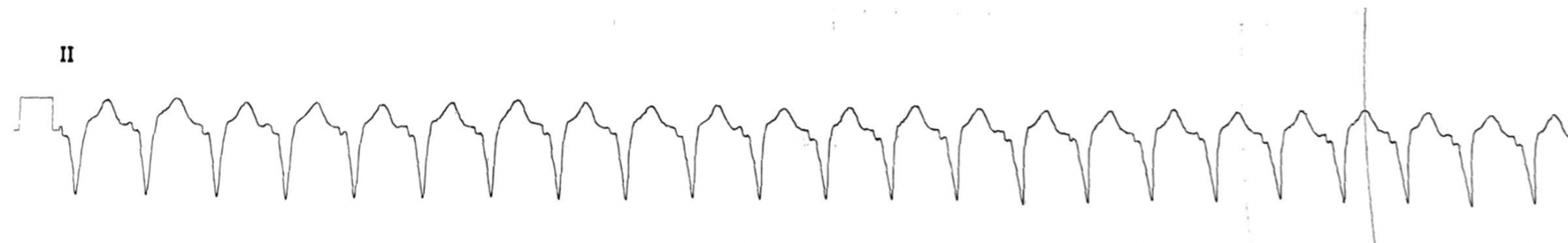 emDOCs.net – Emergency Medicine EducationECG Pointers – The Lewis Lead ...