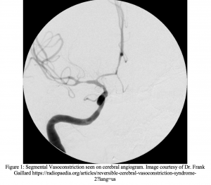 Reversible Cerebral Vasoconstriction Syndrome: ED Presentations ...