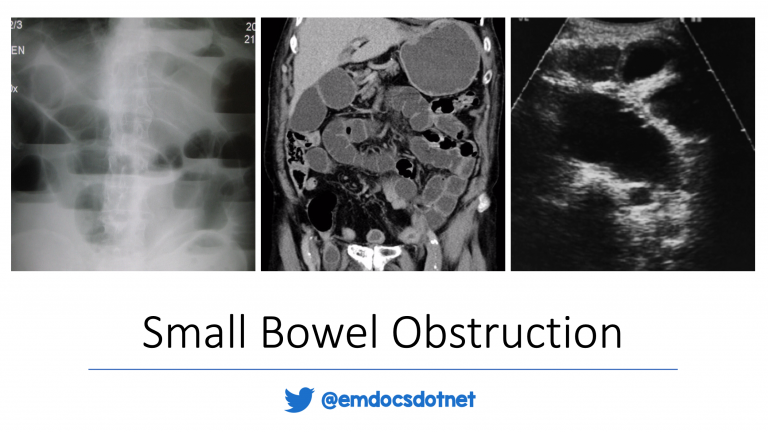 emDOCs Podcast – Episode 29: Small Bowel Obstruction - emDocs
