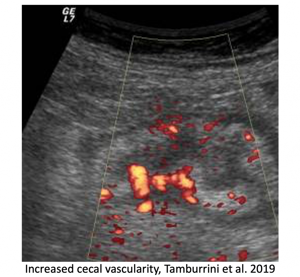 EM@3AM: Typhlitis - emDocs