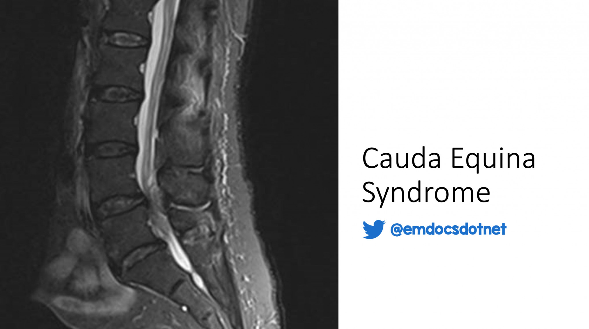 Cauda Equina Syndrome: Why do we miss it? How to improve? - emDocs
