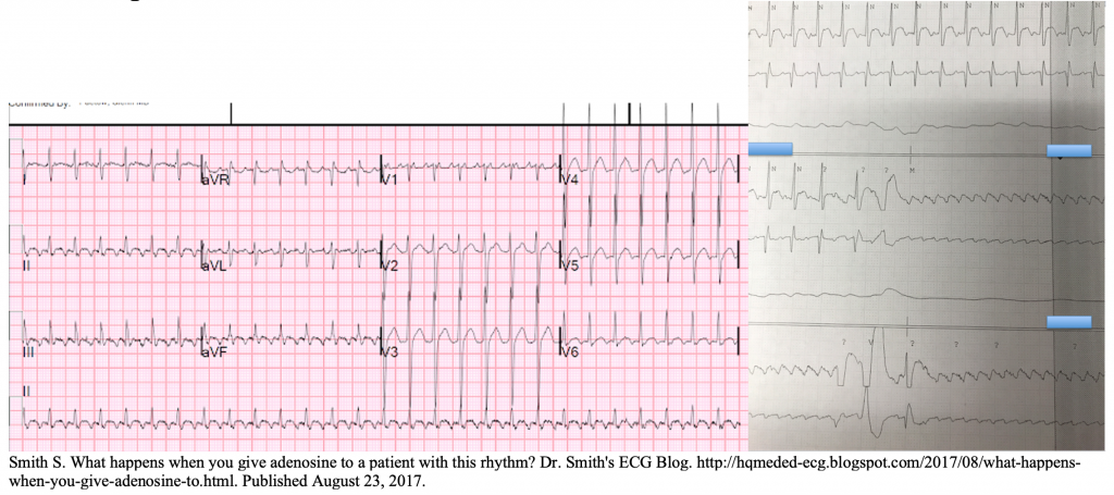 EM@3AM: Atrial Flutter - emDocs